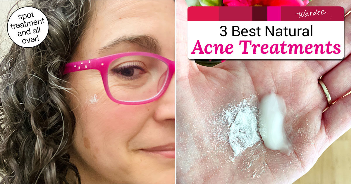 3 Best Natural Acne Treatments: Spot Treatment and All Over!