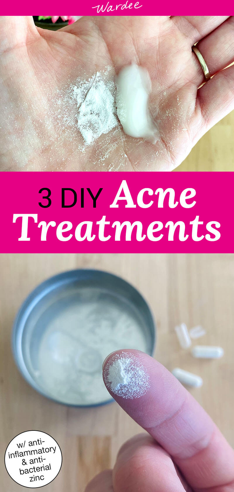 3 Best Natural Acne Treatments: Spot Treatment and All Over!