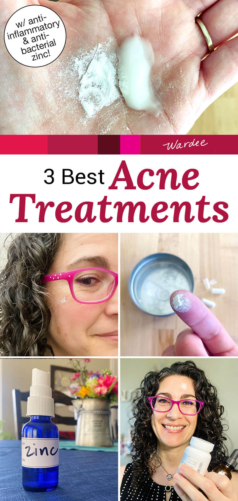 3 Best Natural Acne Treatments: Spot Treatment and All Over!