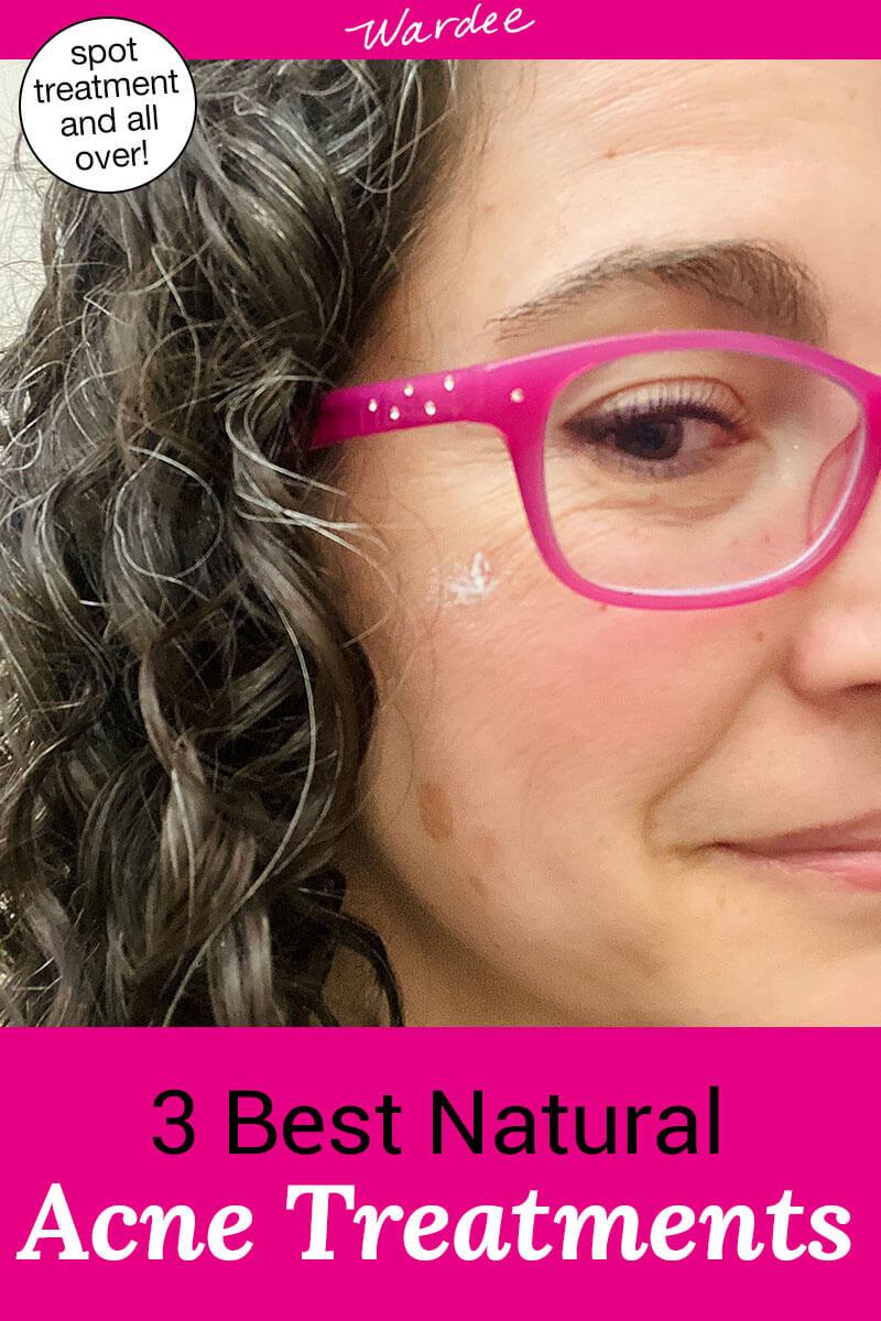 3 Best Natural Acne Treatments: Spot Treatment and All Over!