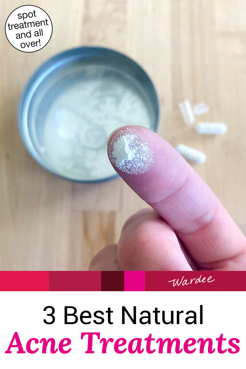 3 Best Natural Acne Treatments: Spot Treatment and All Over!