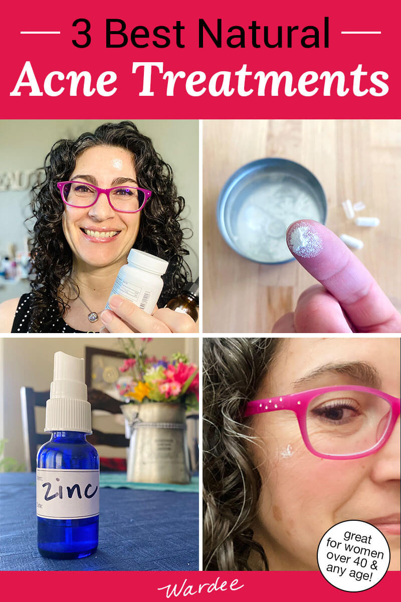 3 Best Natural Acne Treatments: Spot Treatment and All Over!