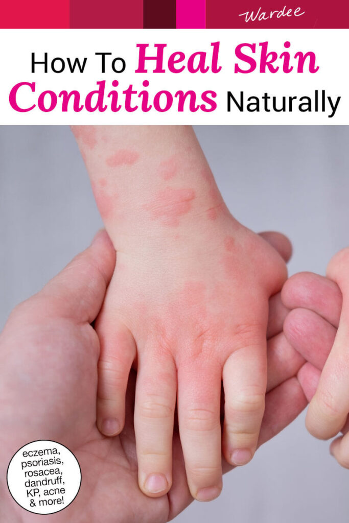 How to Heal Skin Conditions Naturally - Wardee