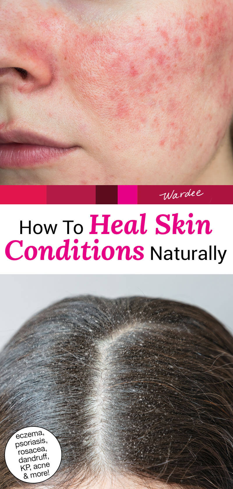 How to Heal Skin Conditions Naturally - Wardee
