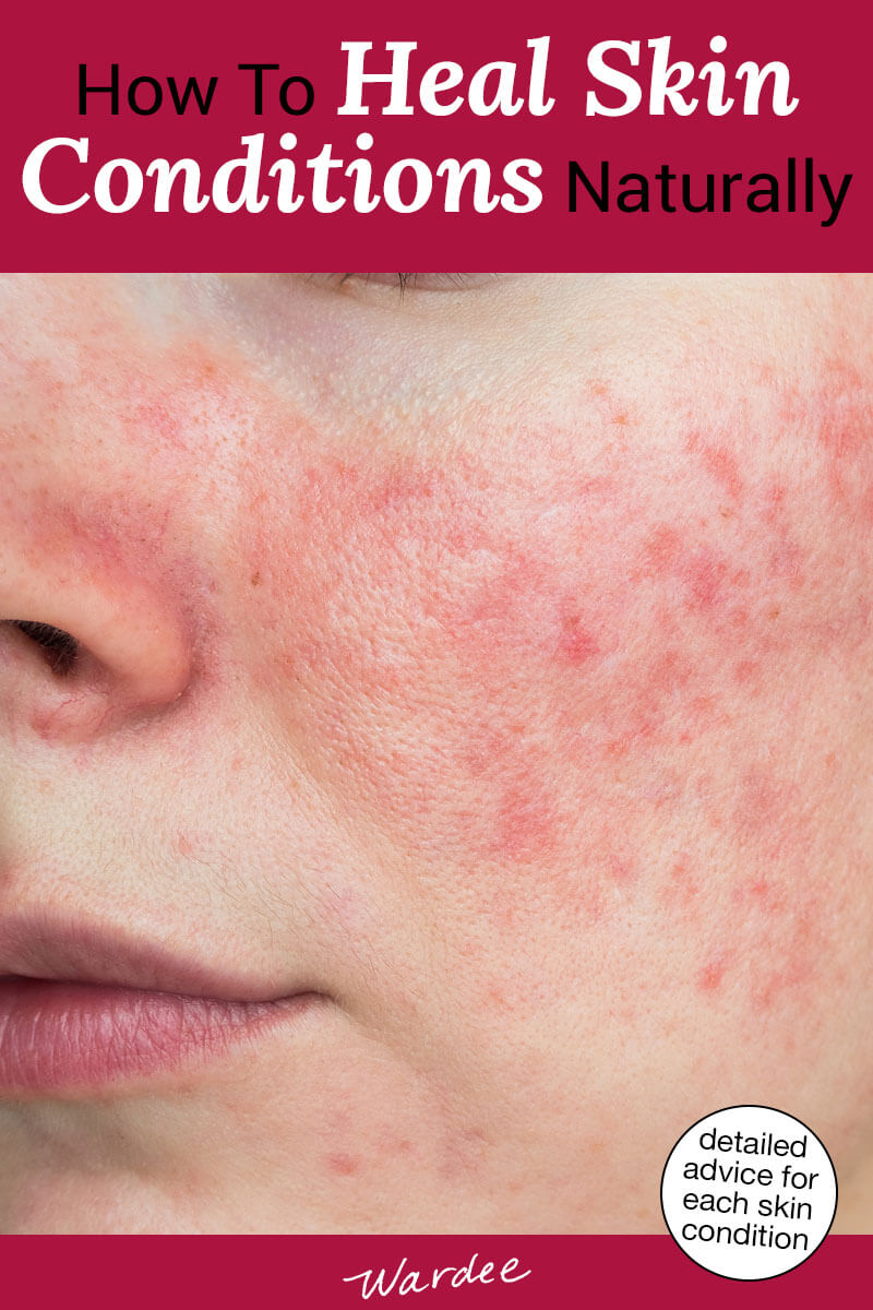 How to Heal Skin Conditions Naturally - Wardee